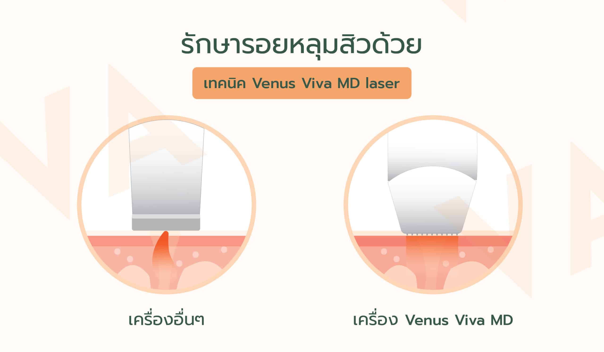 รักษาหลุมสิว คืนผิวเรียบเนียนด้วย เลเซอร์ Venus Viva MD